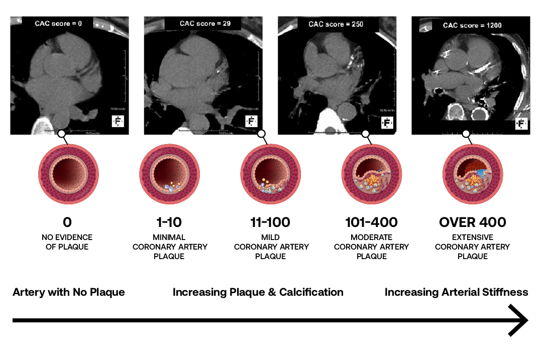 Interpreting Your Augmentation Index and Augmentation Pressure Results ...