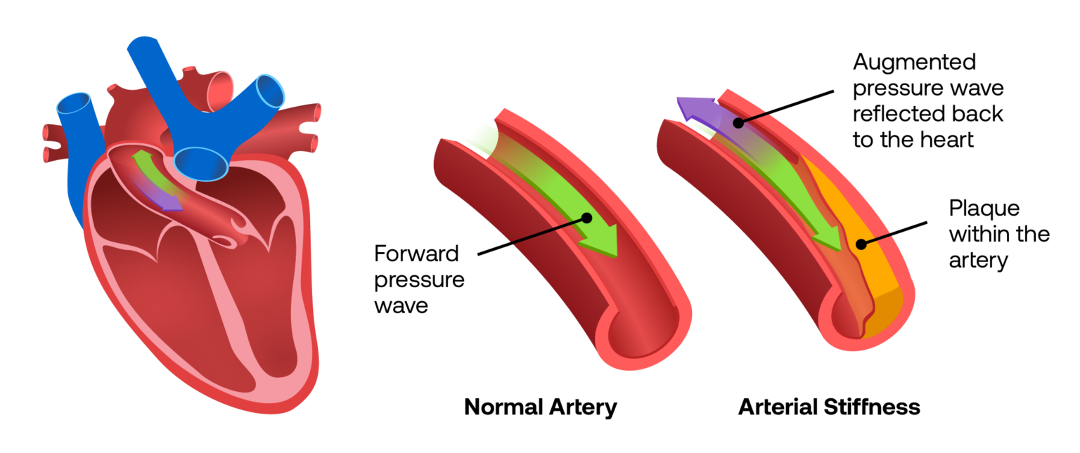 Interpreting Your Augmentation Index and Augmentation Pressure Results ...